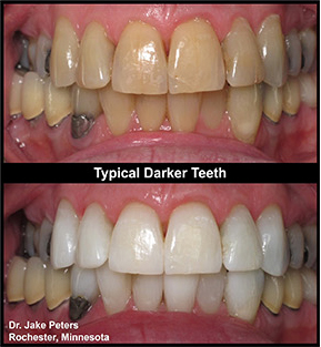 Have you tried the most effective teeth whitening yet?